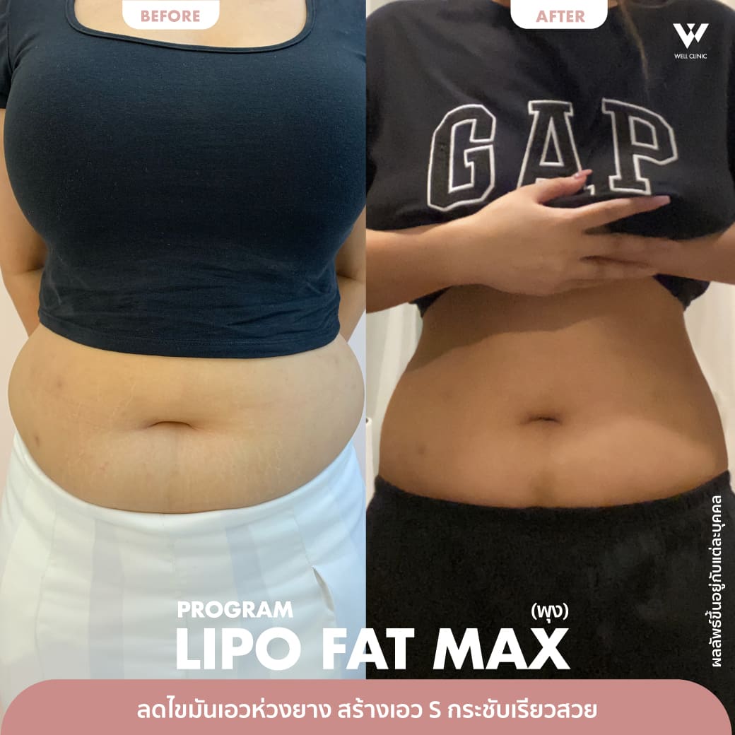 รีวิว Lipo Fat Max - Well Clinic