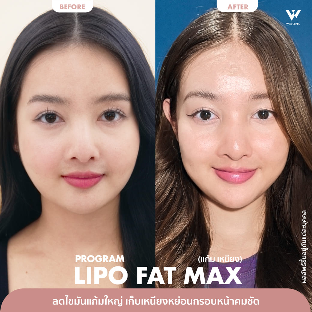 รีวิว Lipo Fat Max - Well Clinic