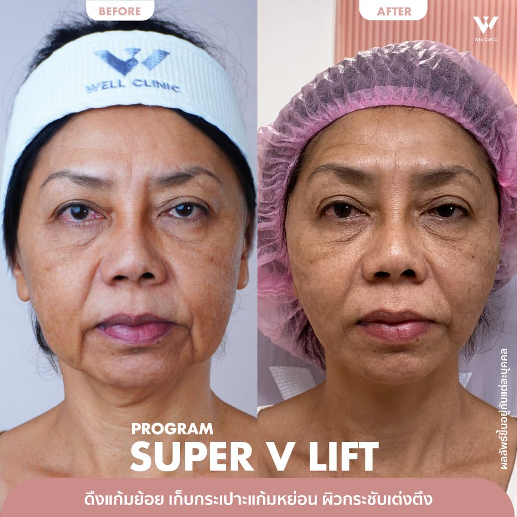รีวิว Super V Lift - Well Clinic