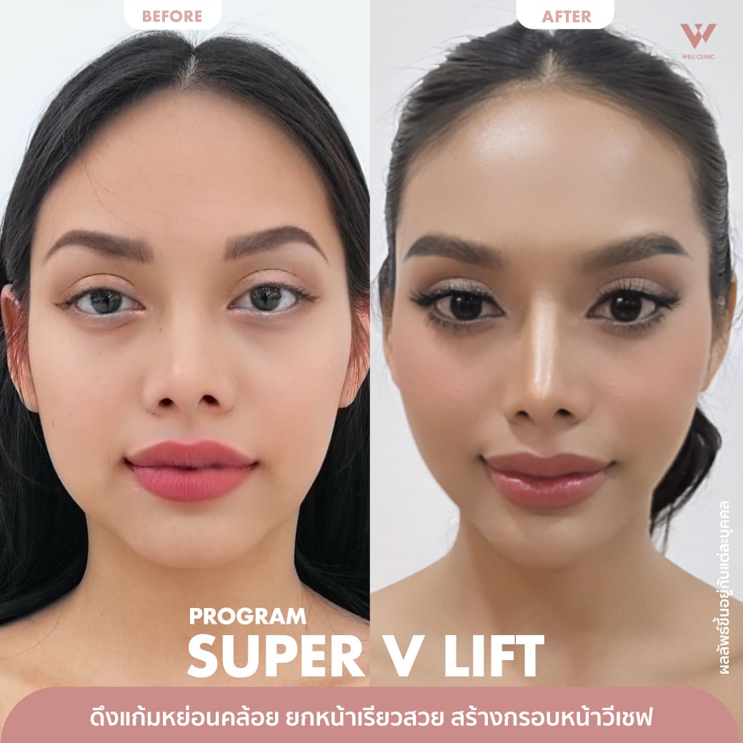 รีวิว Super V Lift - Well Clinic